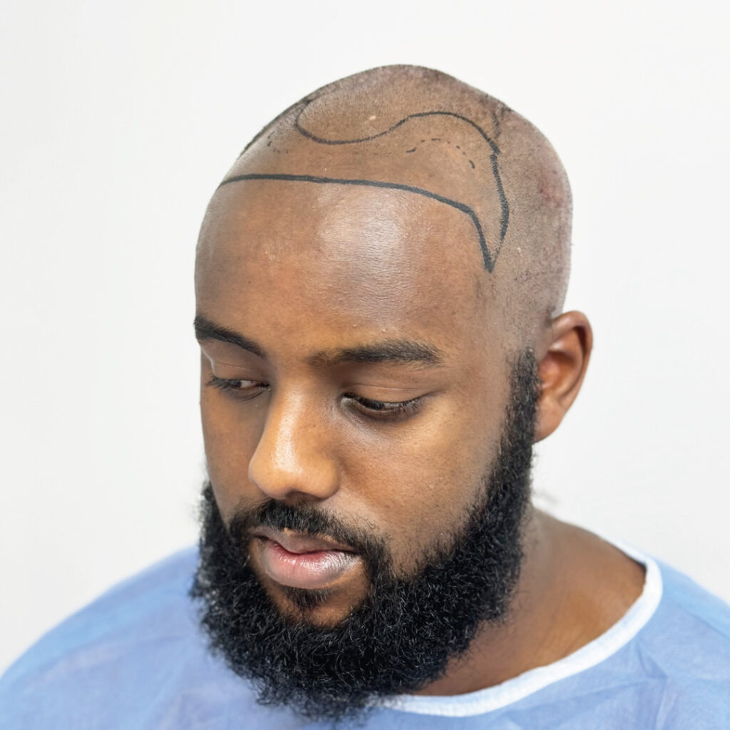 Afro Hair Transplant - A Permanent Solution to Hair Loss and a Receding ...