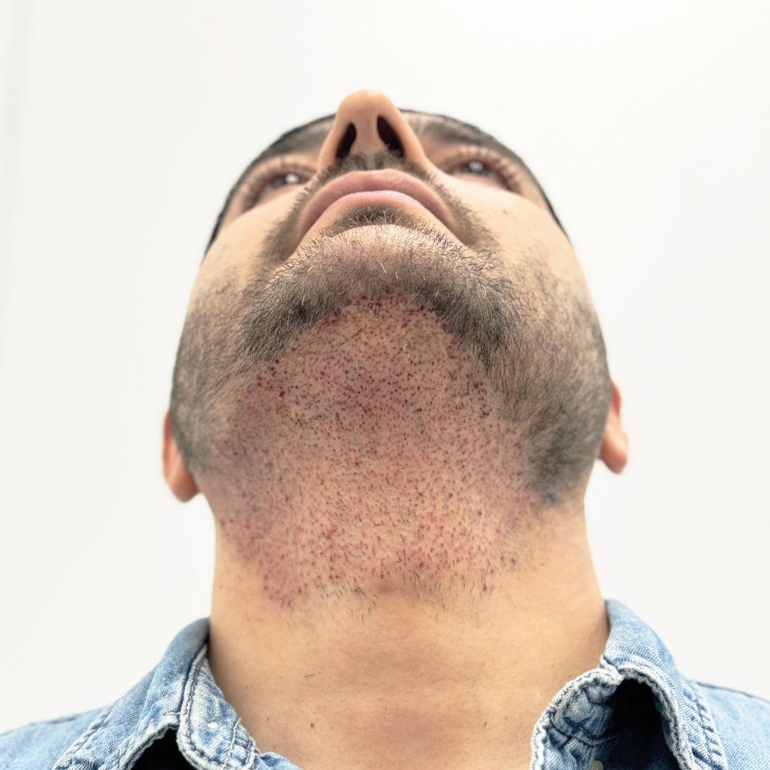 Body Hair Transplant | Dr Resul Yaman Hair Clinic