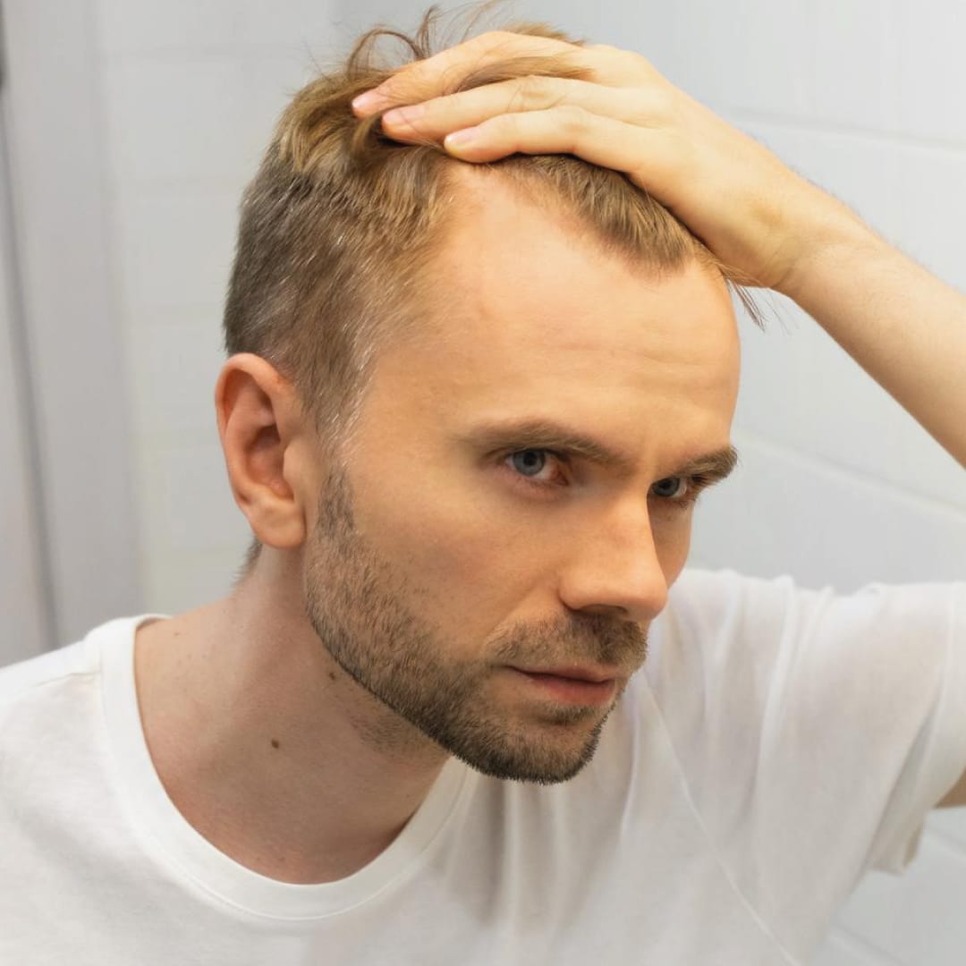 The Norwood 2 – Understanding This Early Stage of Hair Loss - Dr Resul ...